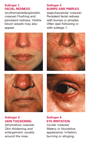 All about rosacea – Simple Sugars